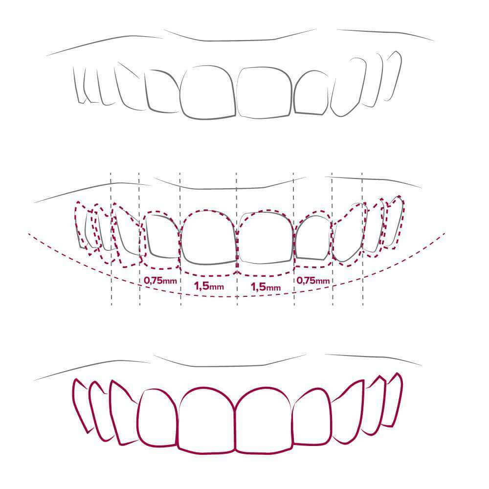 Smile Design - Limelight Dental!