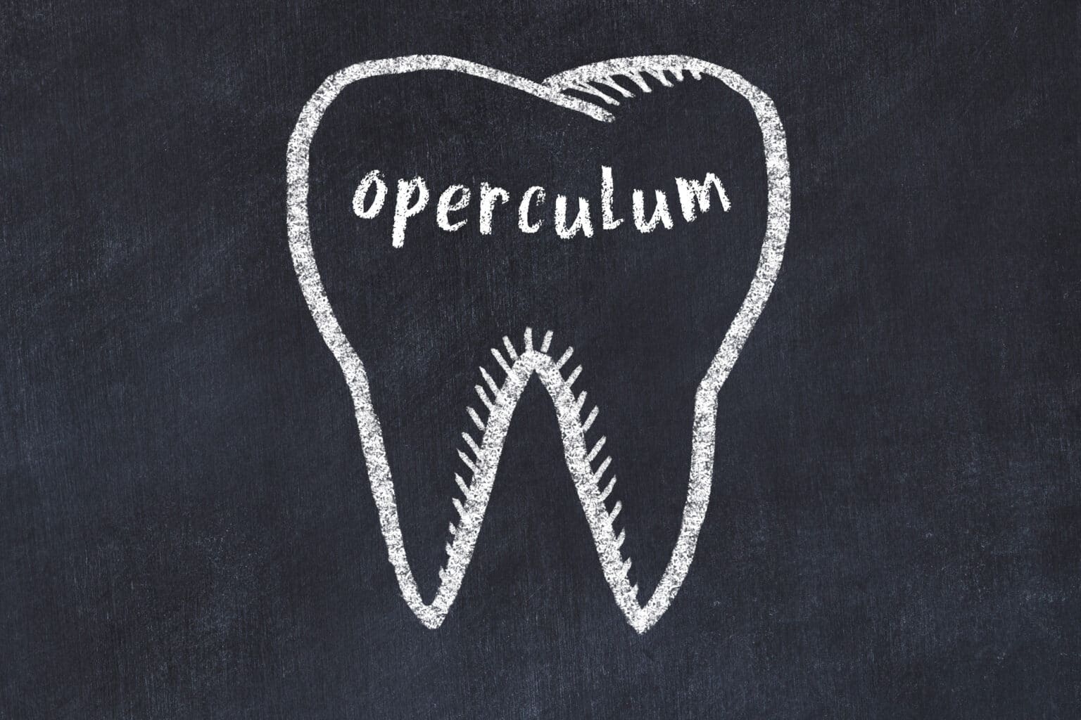 What is a Dental Operculum and Do You Have It?